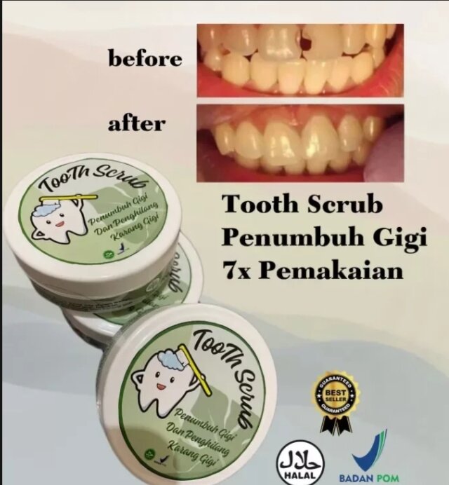 PENUMBUH GIGI ALAMI- Gigi Ompong Tertambal Lagi // Gigi Patah Rapih ...