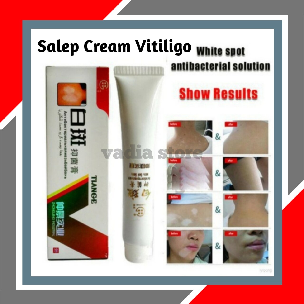 SALEP VITILIGO ORIGINAL 100% Tiange cream psolaren solaren import ...