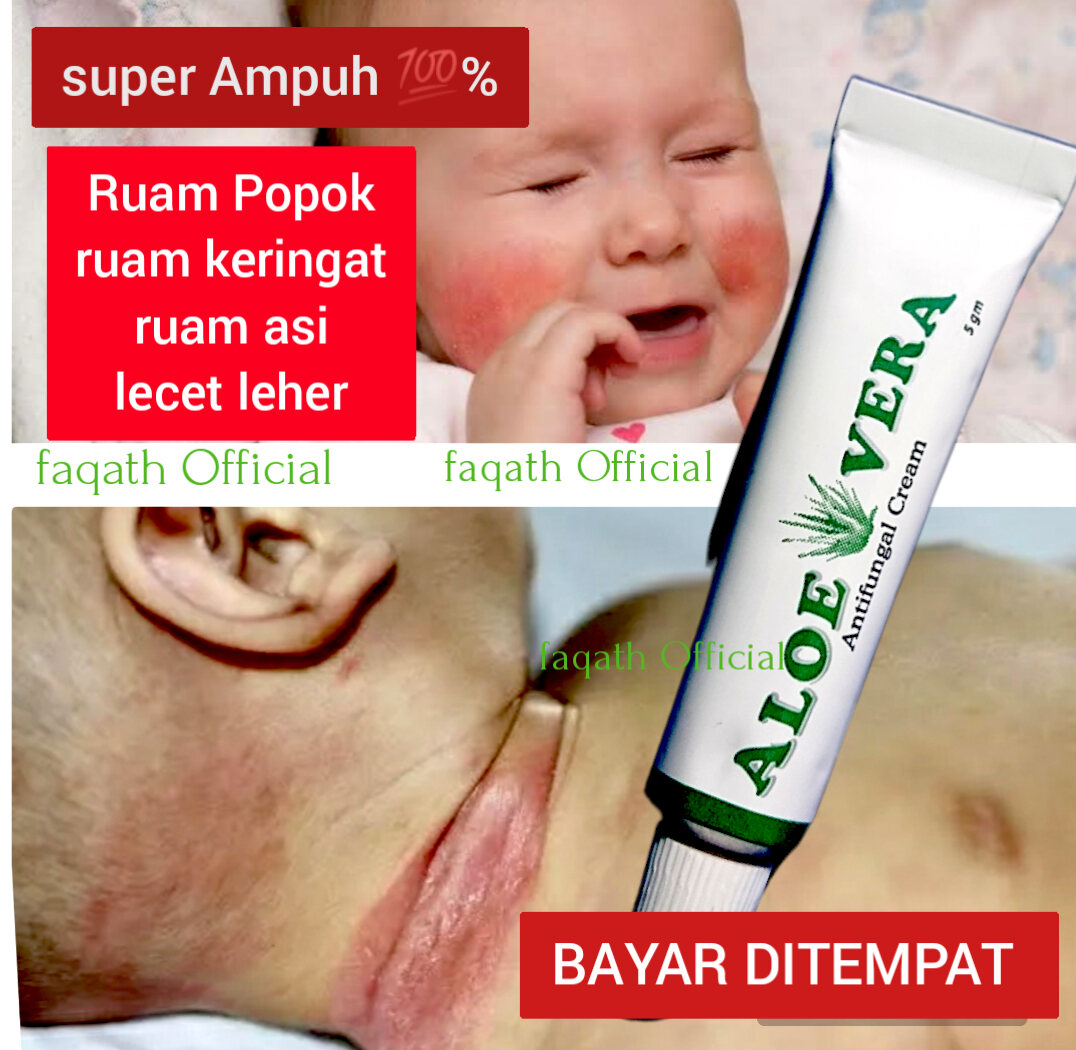 Salep Aloevera Antifungal Menyembuhkan Iritasi Kulit Bayi Ruam Popok ...