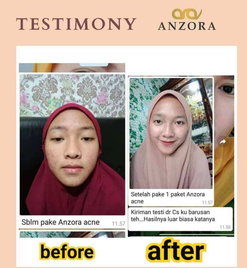 ANZORA SKINCARE GLOW KLINIK, BPOM,AMAN DAN HALAL | Lazada Indonesia