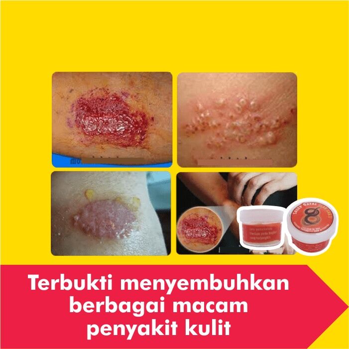 Obat Salep Eksim Kering Ampuh Gatal Gatel Kulit Panu Kurap Kutu Air ...