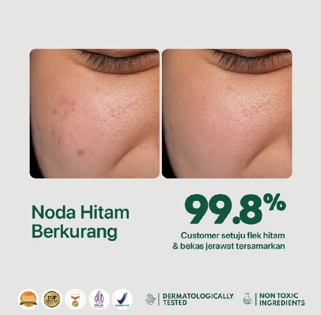 KARMILA ROS NPURE SPOT TREATMENT ACNE SPOT / untuk noda Hitam | Lazada ...